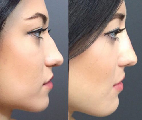 5-Minute Nose Job | Geniusbeauty